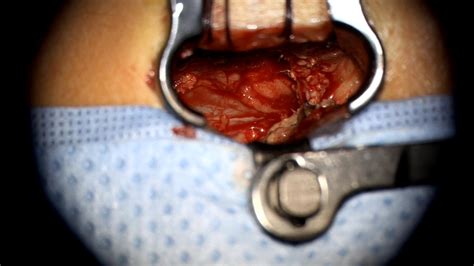 Microsurgical Bilateral Decompression Surgery