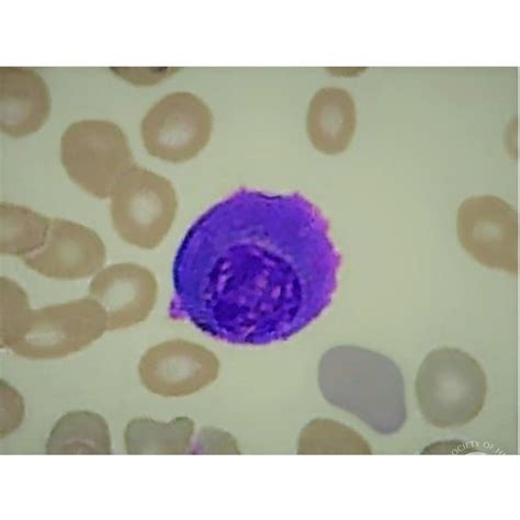 Flame Cells In Plasma Cell Leukemia