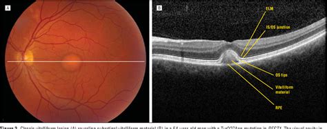 Pseudo Vitelliform Macular Dystrophy