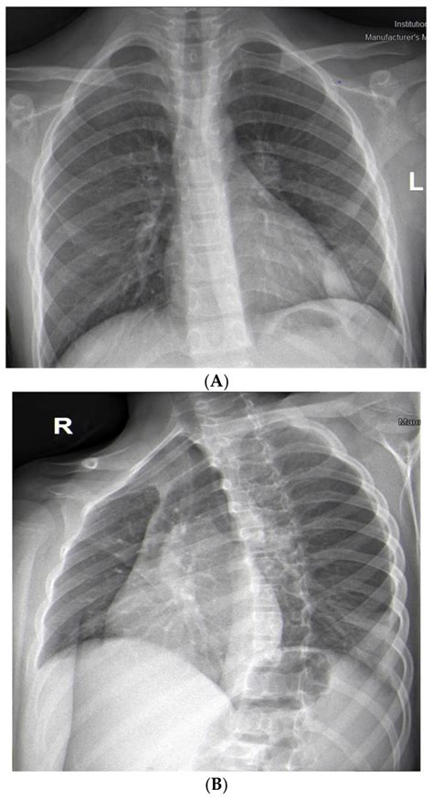 A Frontal Chest X Ray—atelectasis Of The Posterior Basal Segment Download Scientific
