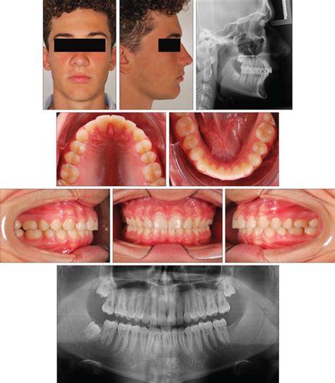 Case 3 Patient After 10 Months Of Functional Treatment With Modified Download Scientific