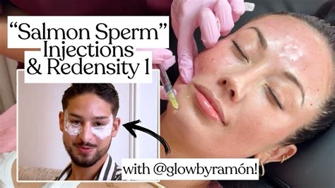 Salmon Sperm Injections And Redensity 1 Getting Anti Aging Treatments In London Youtube