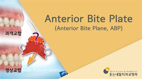 Types Of Bite Plane At Kari Gonzales Blog