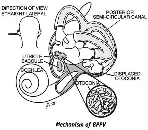 Benign Paroxysmal Positional Vertigo El Paso Tx Wellness Clinic®