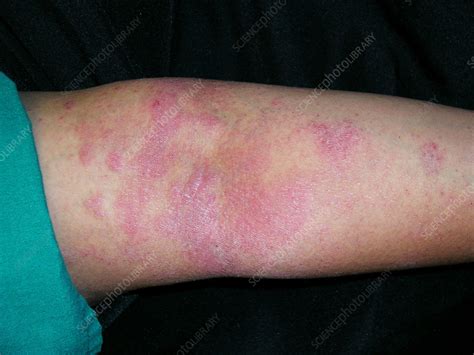 Atopic Dermatitis Stock Image C0567942 Science Photo Library
