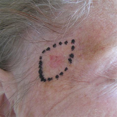 Basaliom Praxisklinik Dr Hasert Berlin Hautarzt