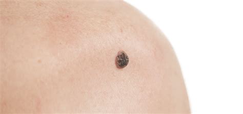 What Does A Small Squamous Cell Carcinoma Look Like