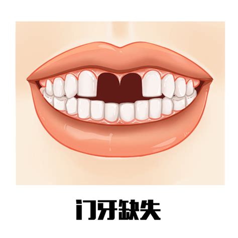 多颗牙缺失 个别牙缺失 门牙缺失 全口牙缺失 牙齿松动 牙齿 口腔 意外脱落 牙齿疾病 修复牙齿 牙槽骨萎缩 残根残冠 牙周疾病 仪表不雅 咀嚼无力 消化疾病 咬合紊乱 说话漏风 种植牙 意外