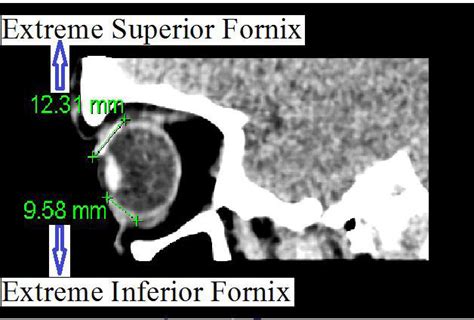 Radiograph The Present New Invention The Method Of Fornix Depth