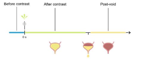 Abdominal Ct Cystogram • Litfl • Radiology Library