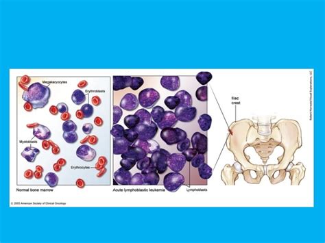 Lumbar Puncture Bone Marrow Aspiration Dr M Torfehnezhad