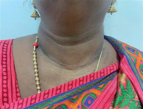 To Drain Or Not To Drain Following Thyroidectomy A Prospective