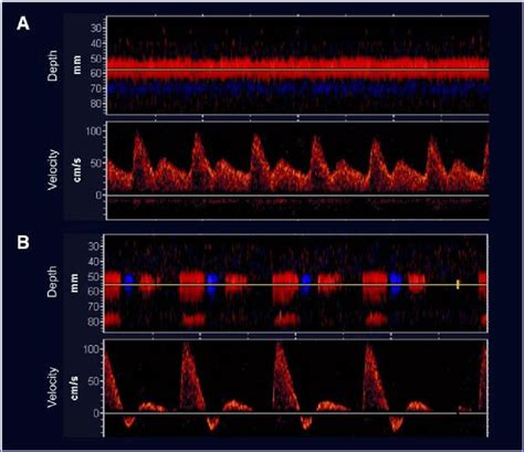 Middle Cerebral Artery Velocity Traces During Hypoxia A And