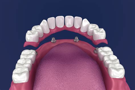 Implant Supported Partial Dentures