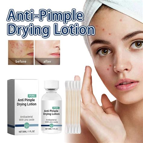 Ziynglg Vegan Pimple Drying Lotion With Oxide For Prone Exfoliates