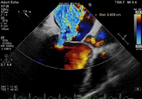 北京友谊医院心内科完成经导管二尖瓣钳夹术 医谱