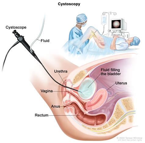 Definition Of Cystoscopy Nci Dictionary Of Cancer Terms Nci