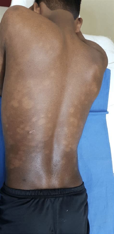 Back Of Trunk Showing Multiple Hypopigmented Macules Download Scientific Diagram
