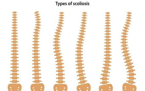 Different Types Of Scoliosis And Causes Aica We Got Your Back
