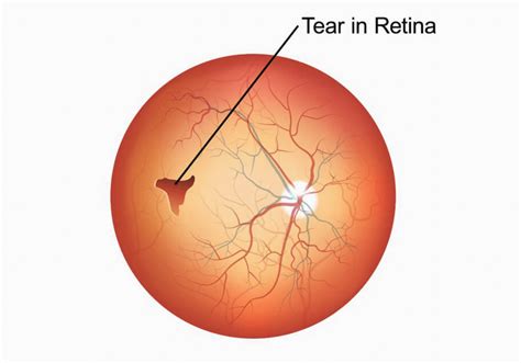 망막박리 증상 레이저 치료 수술 후기