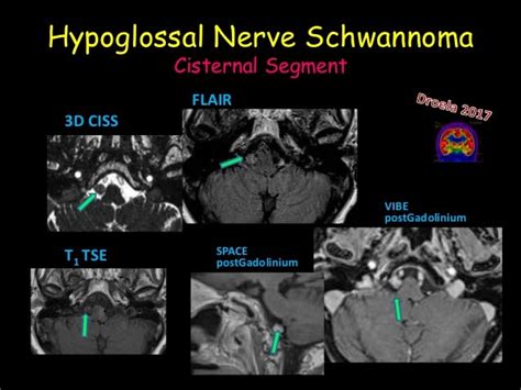 Hypoglossal Nerve Schwannoma