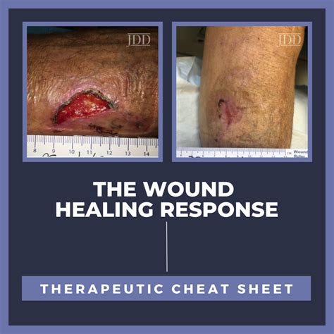 Wound Healing Steps Stages Of Skin Healing Top 4 Crucial Steps For