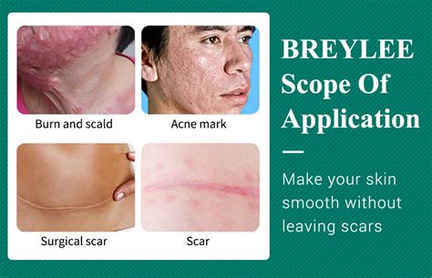 Breylee เจลครีมกําจัดแผลเป็นจากสิว ลบรอยแผลเป็น 3 ชิ้น Shopee Thailand