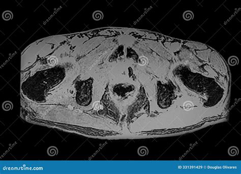 Ct Scan Of Bladder Tumor Stock Illustration Illustration Of Medical 331391429
