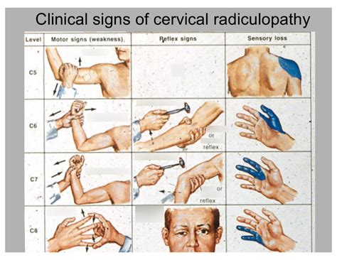 Diagram Of Clinical Signs Of Cervical Radiculopathy Quizlet