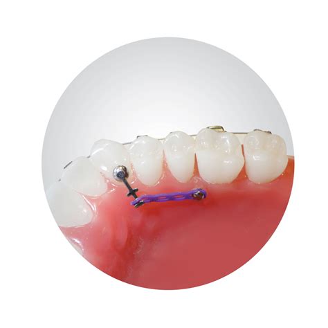 Ios Ortho Tree Hook Pk 10