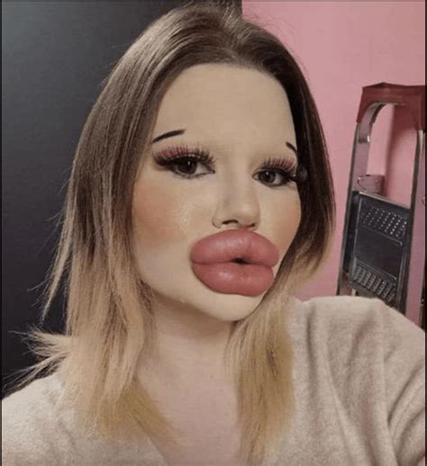 24 Year Old Woman Wants The Biggest Lips In The World Amazing