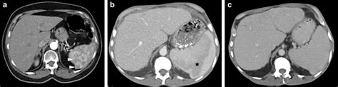 Cross Sectional Imaging Findings Of Splenic Infections Is Differential