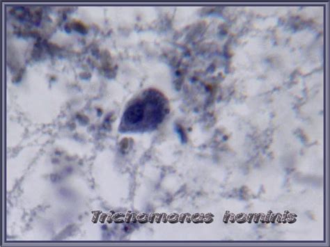 Fun With Microbiology Whats Buggin You Trichomonas Hominis