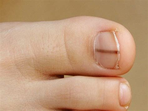 Subunguales Melanom Hautkrebs Subungual Melanoma Symptoms Risk