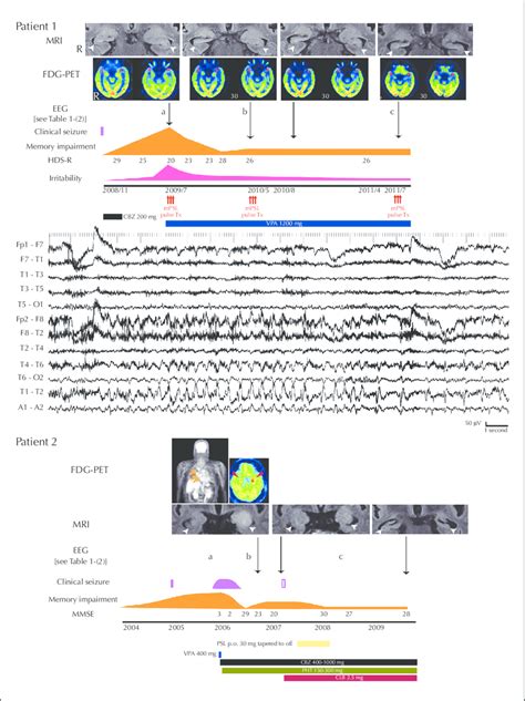 Clinical Course Imaging Findings And Ictal Eeg Pattern The Small