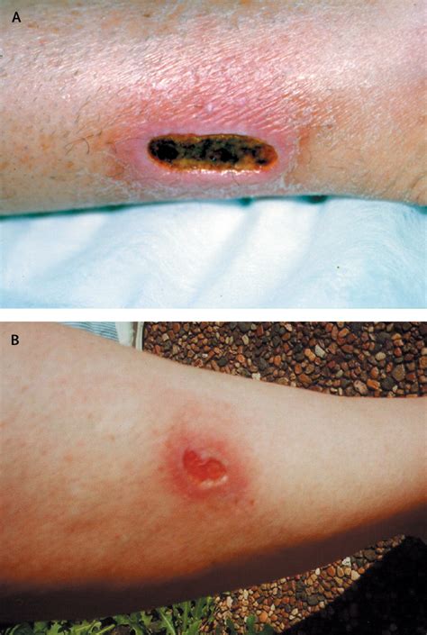 Necrotic Arachnidism The Mythology Of A Modern Plague The Lancet