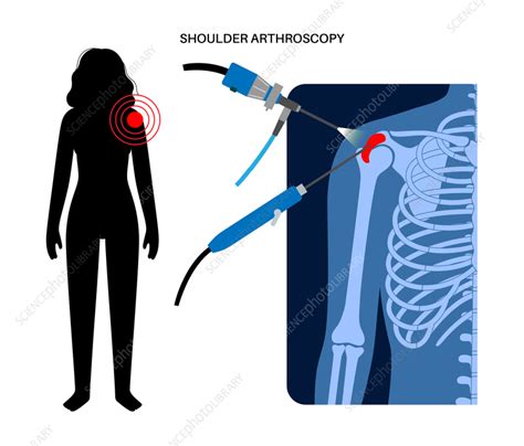 Shoulder Arthroscopy Procedure Illustration Stock Image F0428265