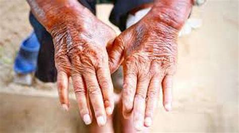 Scleroderma Medizzy