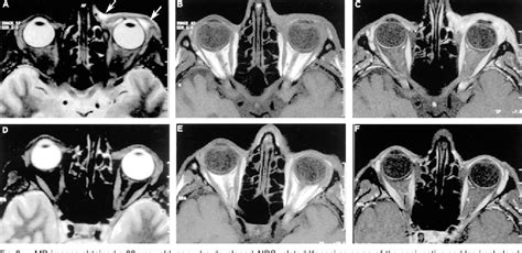 Figure 2 From Pre And Posttreatment Mr Imaging In Aids Related Kaposi