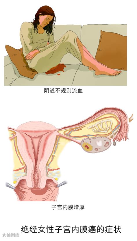 绝经女性子宫内膜癌的症状 医学插画