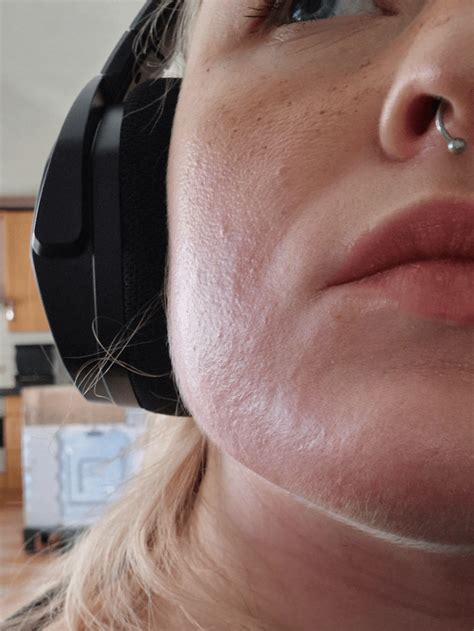 Post Accutane Tretinoin Course Raccutane