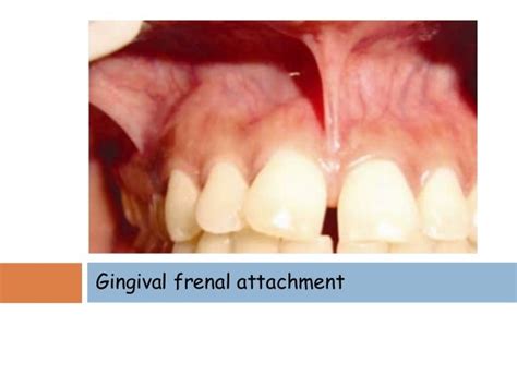Frenum Attachment And Its Management