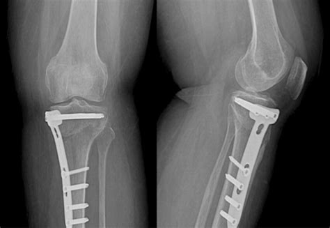 Post Op X Ray Of Ascending Hto Fixed With Tomofix Download Scientific