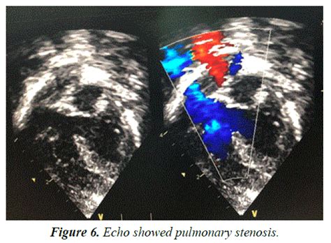 Cornelia De Lange Syndrome With Hypertrichosis In 4 Month Old Infant A