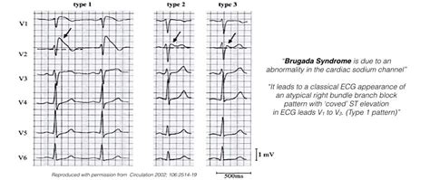 Brugada Syndrome Melbourne Heart Rhythm