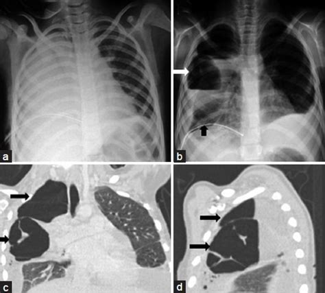 Lung Abscess Due To Streptococcal Pneumonia In A 15 Year Old Girl A Download Scientific
