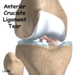 Anterior Cruciate Ligament Acl Tear