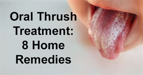 Oral Thrush Treatment 8 Home Remedies David Wolfe Shop