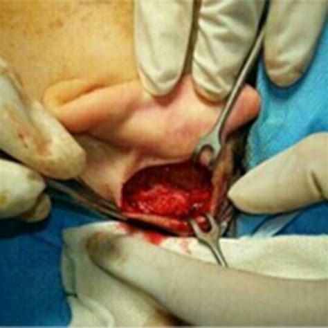 Harvesting Fibroareolar Tissue From Postauricular Region Downloaded