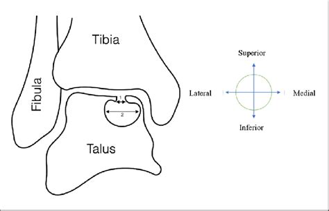 Subchondral Cyst And Size Measurement Figure 4 Fragment And Size